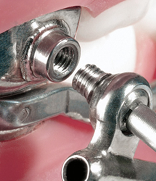 HTH - Hanks Telescoping Herbst® | American Orthodontics