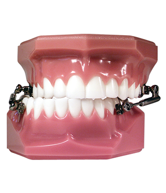 HTH - Hanks Telescoping Herbst® | American Orthodontics